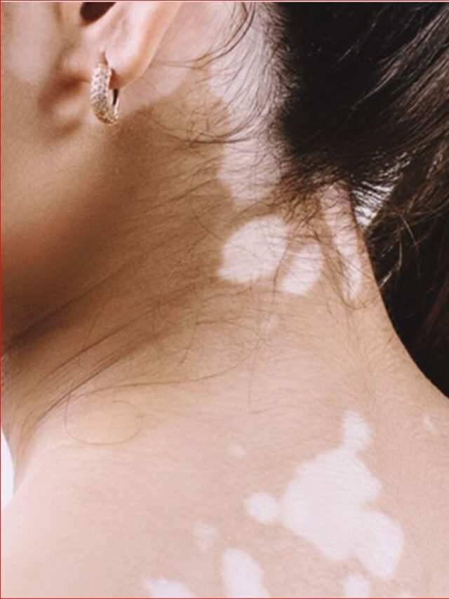 உடம்பில் உள்ள தேமல் மறைய...வீட்டு வைத்தியம்!