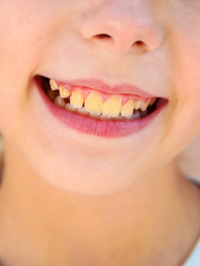 மஞ்சள் கறை கொண்ட பற்களை வெண்மையாக்க உதவும் சூப்பர் டிப்ஸ்..!!